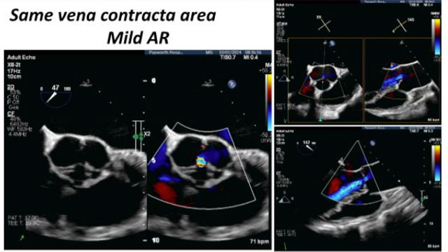 The aortic regurgitation problem: an imaging and practical perspective