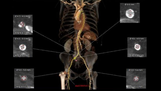 TAVI essentials: anatomical factors, prosthesis selection, and ...