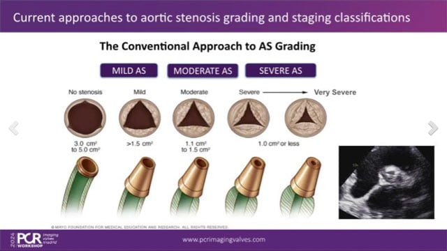 Unraveling aortic valve complexities: grading challenges, intervention decisions, and advanced ...