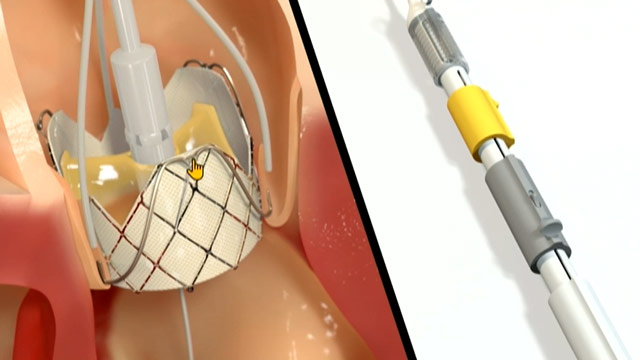 A dedicated TAVI valve for aortic regurgitation: the J-VALVE solution