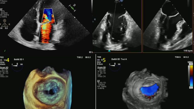 Featured cases - Complications of mitral TEER