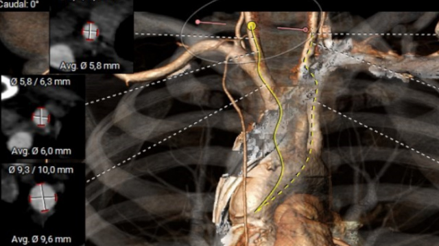 Featured cases - Non-transfemoral TAVI access