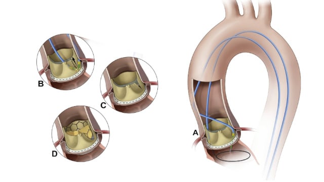 Featured cases - TAVI coronary protection strategies (Part 2)