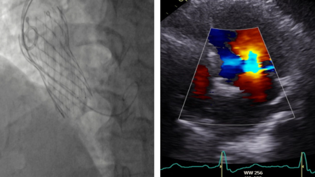 Featured cases - TAVI embolisation (Part 1)