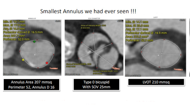Featured cases - TAVI in challenging annular anatomy