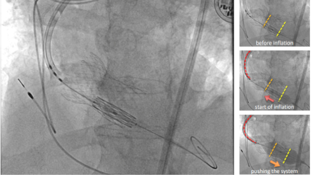 Featured Cases - TAVI-in-TAVI (Part 2)