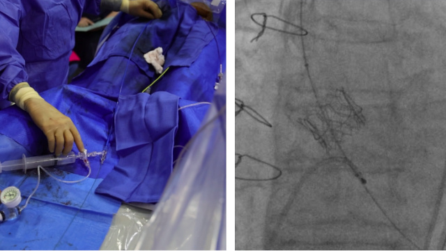 Featured cases - Valve-in-valve TAVI with balloon fracture