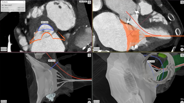 How to establish a mitral TEER programme