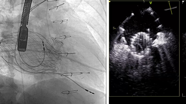 Rapid-fire - Mitral and tricuspid interventions