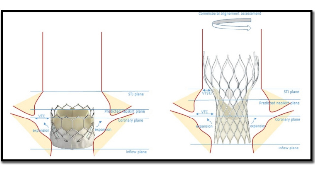 Rapid-Fire - TAVI-in-TAVI (Part 2)