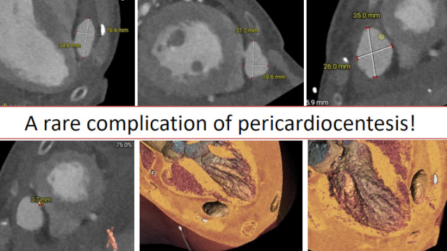 Rapid-fire - Transcatheter solutions for rare complications