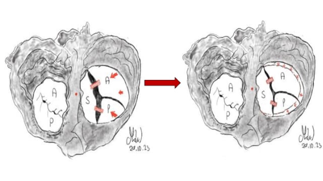 Rapid-Fire - Tricuspid TEER
