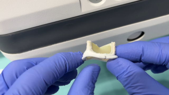 TAV-in-SAV for surgical bioprosthetic valve failure