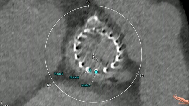 TAV-in-TAV for transcatheter heart valve failure