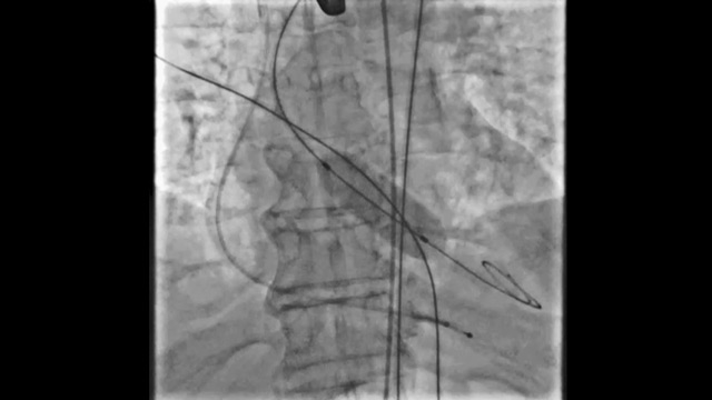 TAVR implantation techniques: are they the same for all self-expanding ...