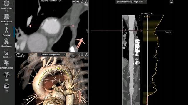 The many faces of complex TAVI