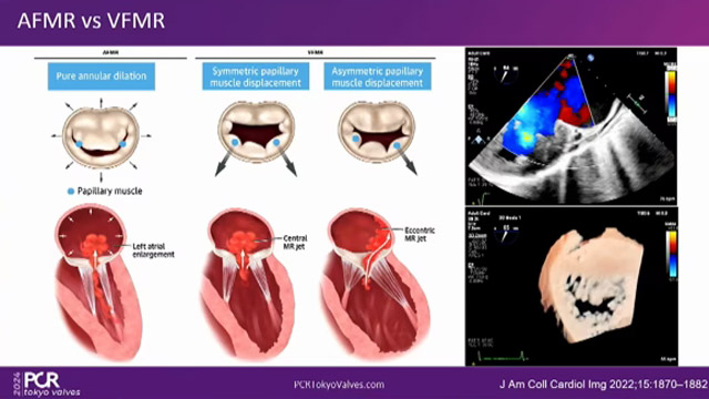 Challenges in TEER for secondary mitral regurgitation