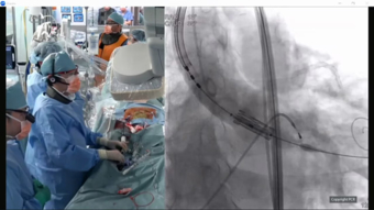 TAVI (Transcatheter aortic valve implantation)