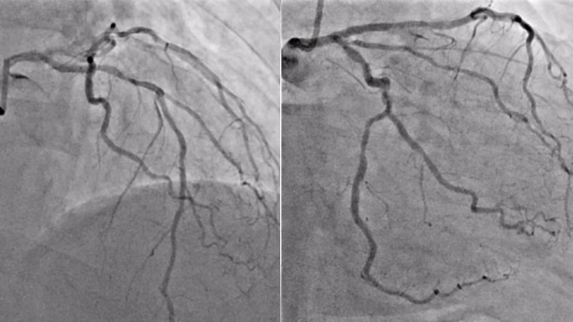 DCB in diffuse disease and small vessels: LIVE Educational Case from ...