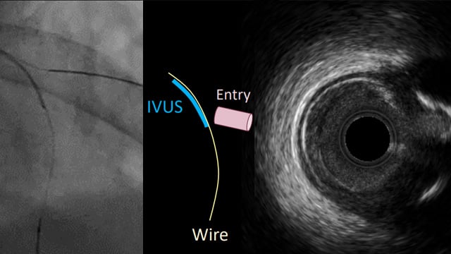 IVUS or OCT? Choosing the right imaging for the right lesion - A case ...