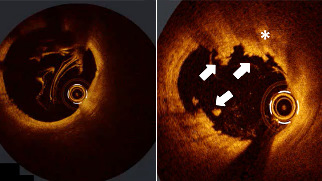 STEMI, thrombus and emergencies