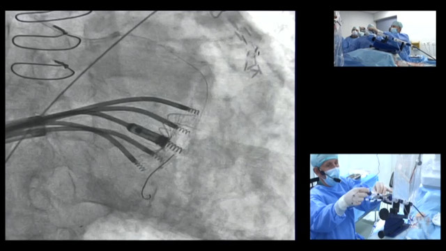Active posterior leaflet replacement - A novel transcatheter approach for the treatment of ...
