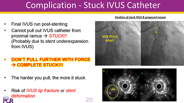 Acute complications during distal left main PCI - Part 1
