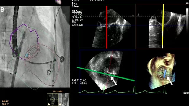 Advanced imaging in structural heart disease interventions