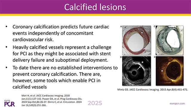 Challenges and risks of percutaneous treatment of calcified lesions