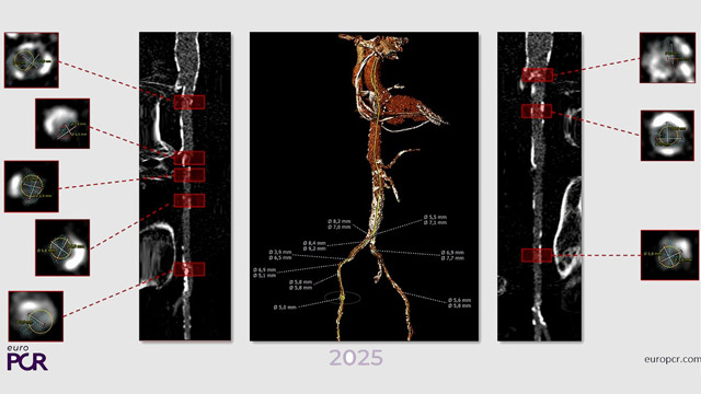 Challenging vascular access and closure management
