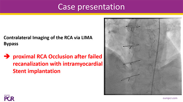 CTO after CABG: complex but feasible