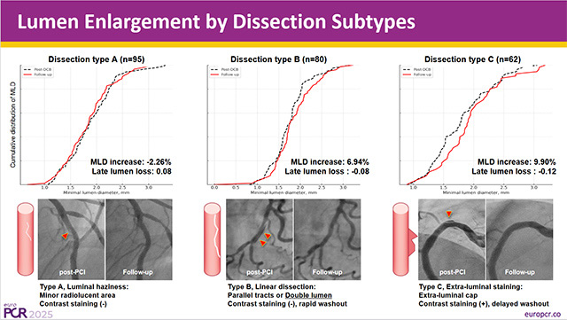 DCB-PCI in de novo lesions