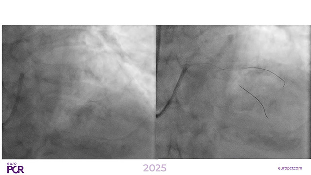 DES and DCB for bifurcation treatment