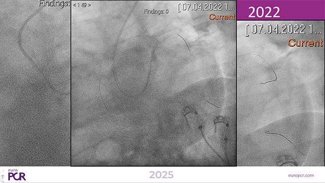 Difficult ACS case management and complication