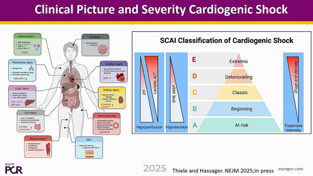 Extensive anterior STEMI - Treatment strategies from SCAI A to E