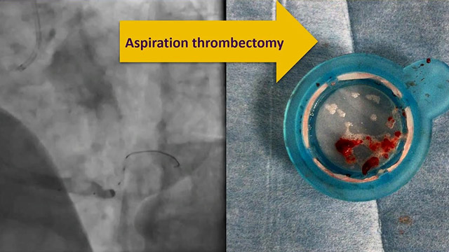High thrombus burden in STEMI