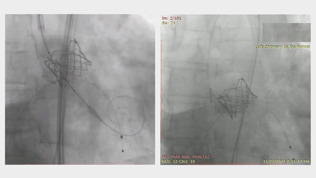Hotline TAVI 2: outcomes with new and established devices