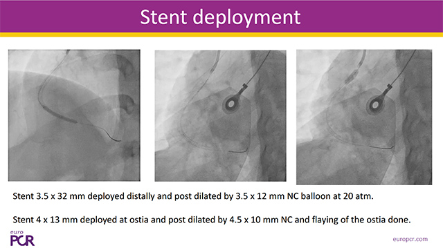 How to deal with ostial right coronary artery CTOs