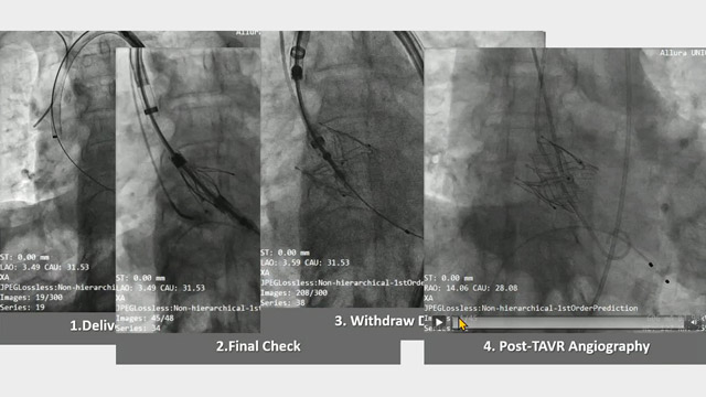 Innovations in transcatheter aortic valve devices and techniques