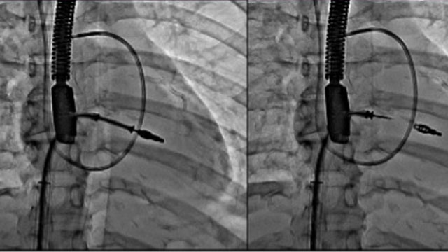 Mitral TEER in challenging scenarios - Part 1