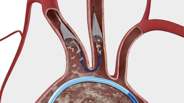 Major Late-Breaking Trials from EuroPCR 2025
