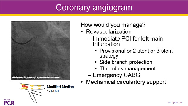 Management of complex left main trifurcation lesion