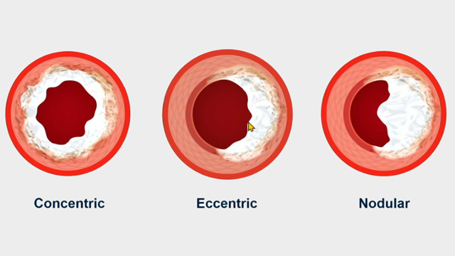 Novel Hertz Contact Intravascular Lithotripsy: could we achieve more in ...