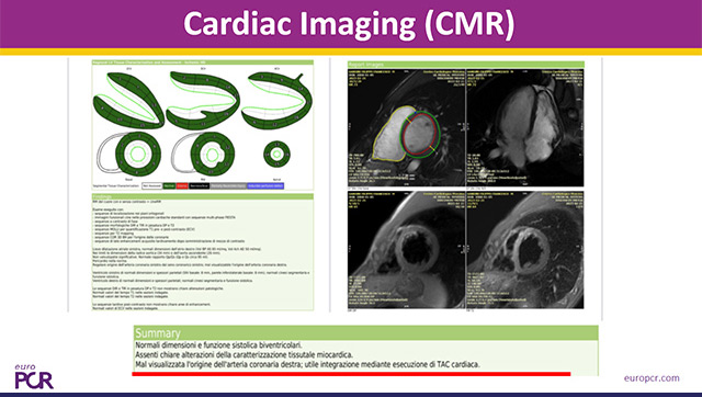 PCI in a challenging coronary anatomy
