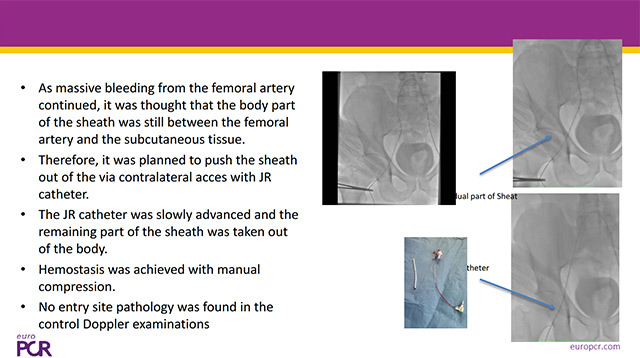Retrograde removal of the broken sheath