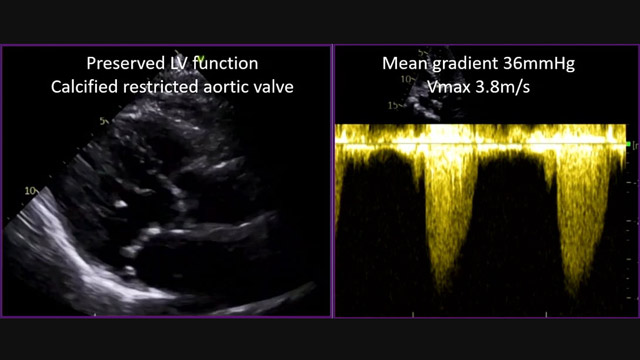 TAVI for asymptomatic aortic stenosis after EARLY TAVI - TAVI and ...