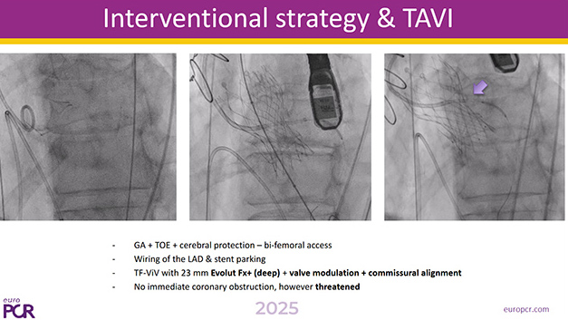 TAVI new devices