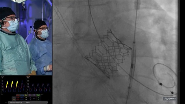 TAVI (Transcatheter aortic valve implantation)
