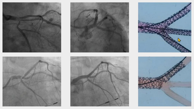 Through decisions in complex left main PCI – Left main trifurcation