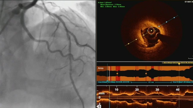 Transforming PCI: mastering the implementation of drug-eluting balloons